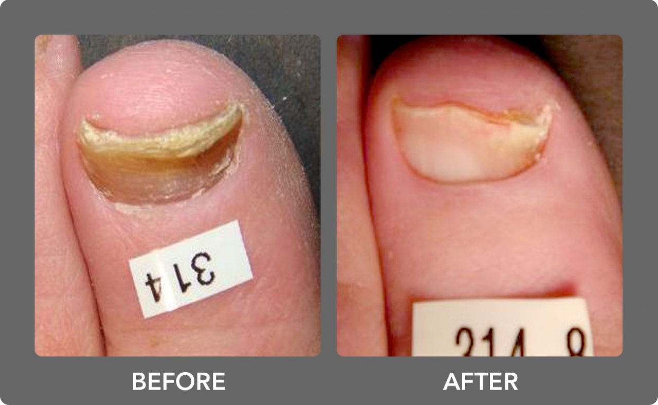 Toenail Fungus Treatment with Pinpointe Foot Laser Photo Gallery - NuvoLase