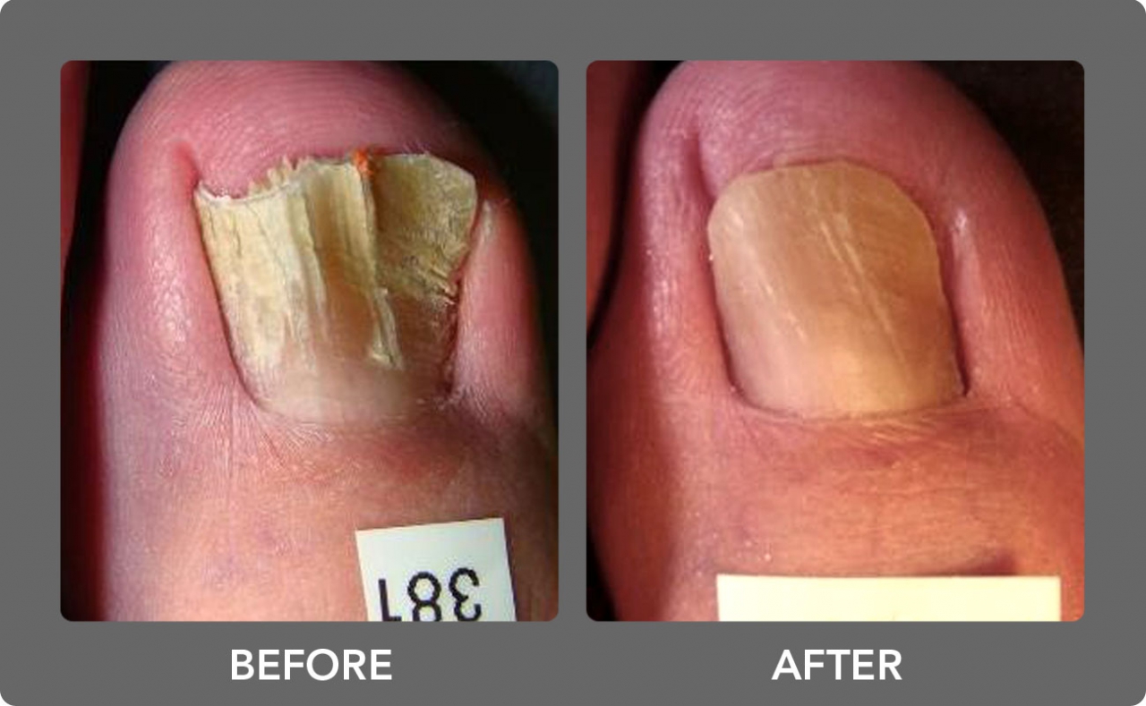 Toenail Fungus Treatment with Pinpointe Foot Laser Photo Gallery - NuvoLase